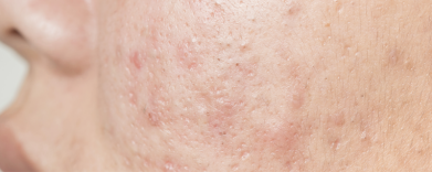 Acne comedonica: mee-eters | Oorzaak en tips | Sproet