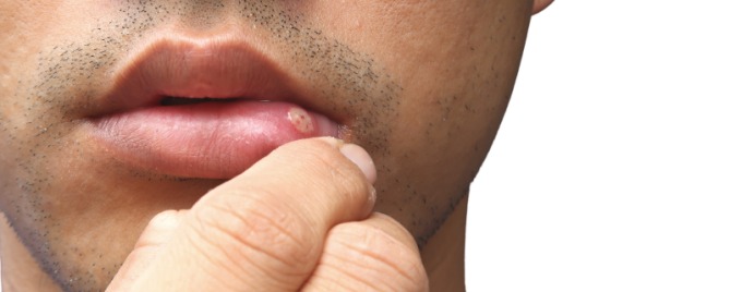 Aften | Oorzaak en mijn tips als huidtherapeut | Sproet