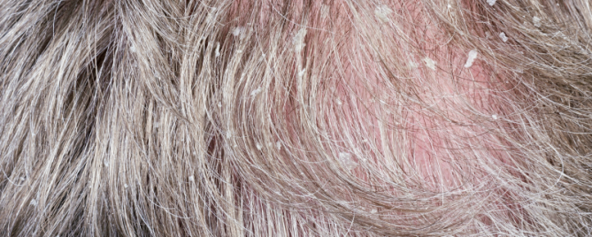 Hoofdhuid schilfers | Oorzaak en oplossing | Sproet