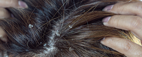 Hoofdhuid schilfers | Oorzaak en oplossing | Sproet