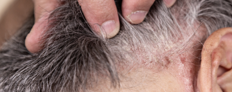 Hoofdhuid schilfers | Oorzaak en oplossing | Sproet