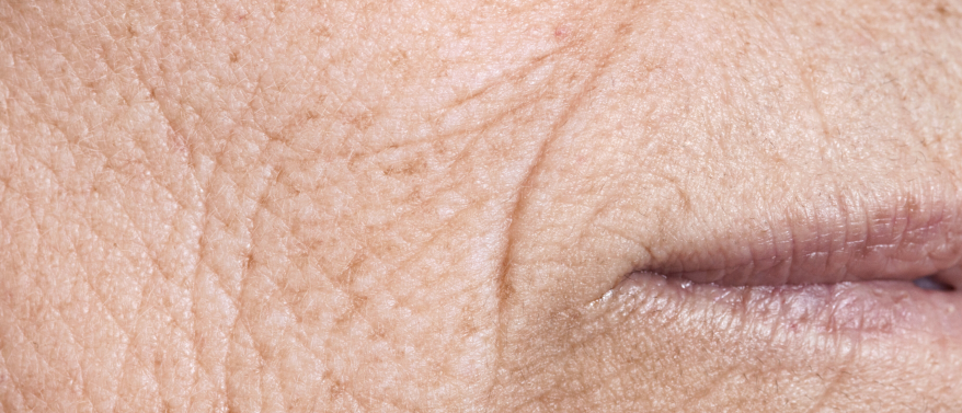 Rimpels | Oorzaak en tips | Anti rimpel crème | Sproet