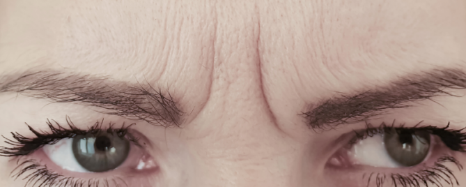 Rimpels | Oorzaak en tips | Anti rimpel crème | Sproet