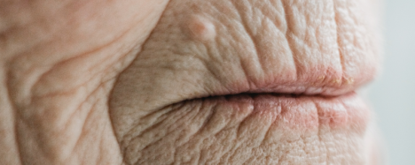 Rimpels | Oorzaak en tips | Anti rimpel crème | Sproet