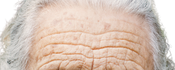 Rimpels | Oorzaak en tips | Anti rimpel crème | Sproet