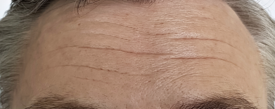 Rimpels | Oorzaak en tips | Anti rimpel crème | Sproet