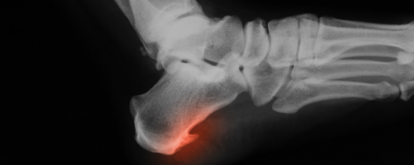 Hielspoor | Oorzaak en behandeling | Sproet