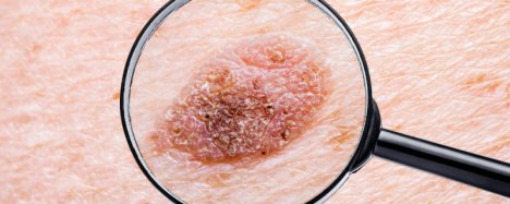 Melanoom | Huidkanker | Sproet