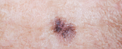 Melanoom | Huidkanker | Sproet