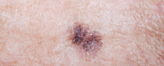 Melanoom | Huidkanker | Sproet