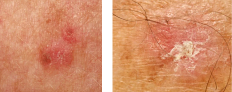 Actinische keratose | Voorstadia van huidkanker | Sproet