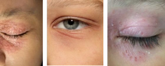 Dermatitis periocularis | Rode uitslag rond ogen | Sproet