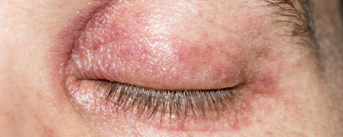 Dermatitis periocularis | Rode uitslag rond ogen | Sproet