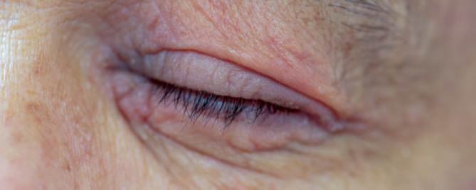 Dermatitis periocularis | Rode uitslag rond ogen | Sproet