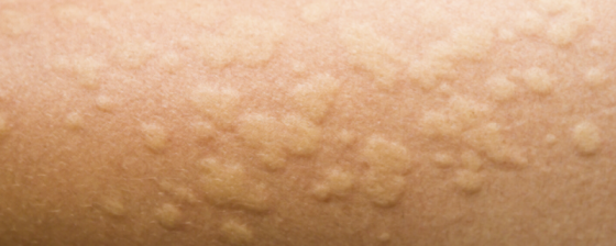 Jeukende rode galbulten | Mijn tips! | Sproet