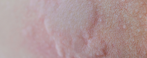 Jeukende rode galbulten | Mijn tips! | Sproet