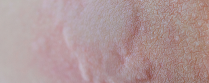 Jeukende rode galbulten | Mijn tips! | Sproet