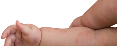 Jeukende rode galbulten | Mijn tips! | Sproet