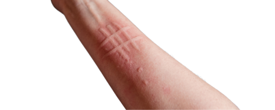 Jeukende rode galbulten | Mijn tips! | Sproet