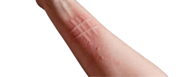 Jeukende rode galbulten | Mijn tips! | Sproet