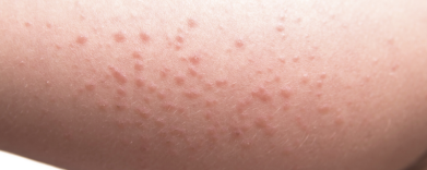 Eikenprocessierups bultjes: wat te doen? | Sproet