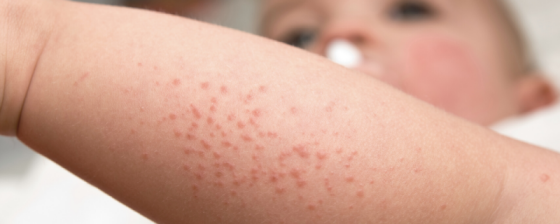 Eikenprocessierups bultjes: wat te doen? | Sproet