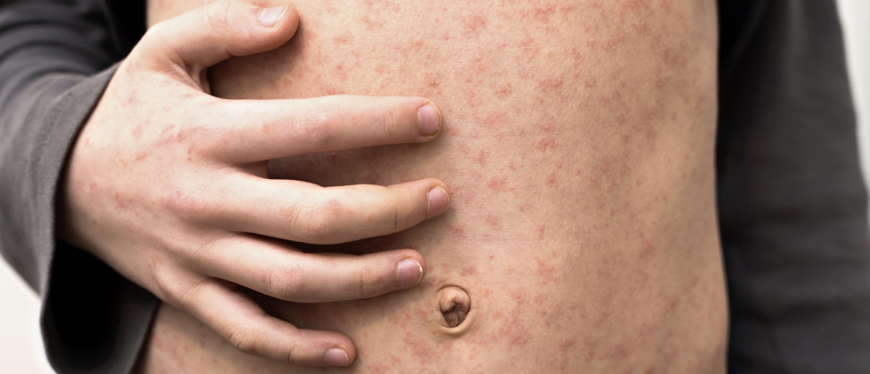 Huidproblemen baby en kinderen | Sproet