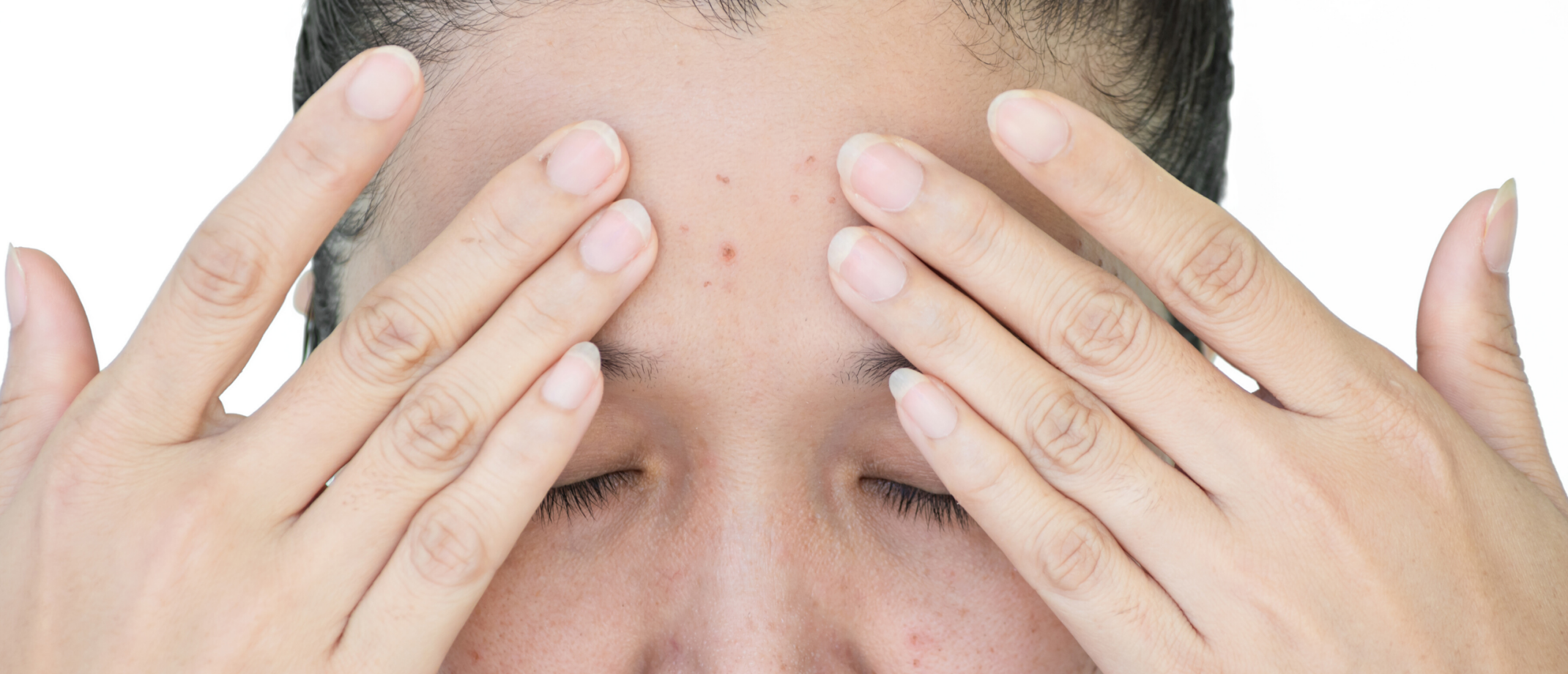 Huidproblemen in het gezicht | Oorzaak en tips | Sproet