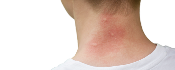 Muggenbulten: zwelling na muggenbeet | Sproet