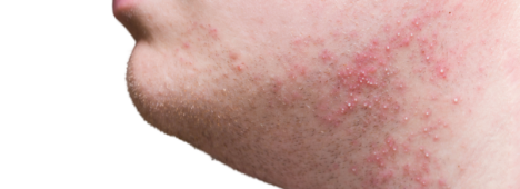 Ingegroeide haren: scheerbultjes, scheerirritatie