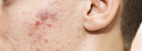 Acne Keloidalis | Oorzaak en behandeling | Sproet