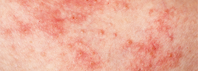 Blaasjeseczeem | Oorzaak en tips | Sproet