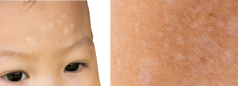 Confettihuid | Oorzaak en is er een oplossing? | Sproet