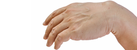 Atheroomcyste: verstopte talgklier