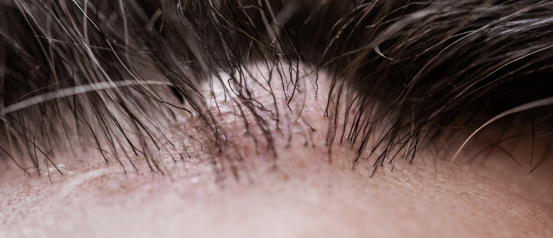 Atheroomcyste: verstopte talgklier