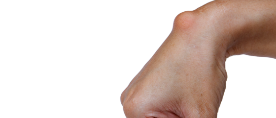 Atheroomcyste: verstopte talgklier