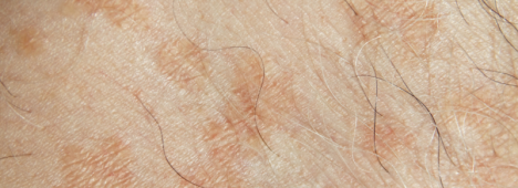 Pityriasis versicolor: vlekjes op de huid | Sproet