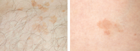 Pityriasis versicolor: vlekjes op de huid | Sproet