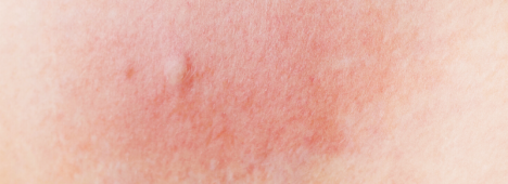 Eikenprocessierups bultjes: wat te doen? | Sproet