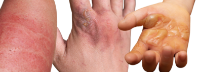 Wonden | Hoe te verzorgen? | Sproet