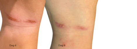 Wonden | Hoe te verzorgen? | Sproet