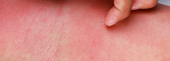 Wondroos | Oorzaak en behandeling | Sproet