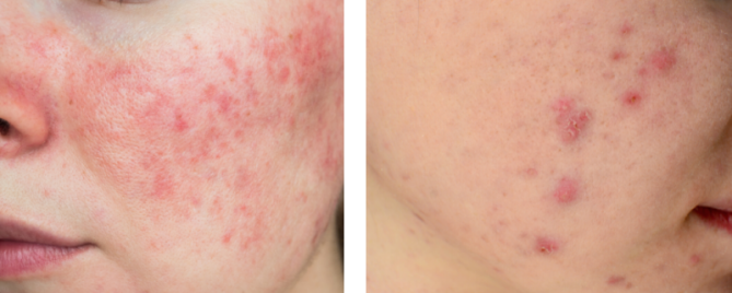 Acne bij volwassenen | Wat te doen? | Sproet