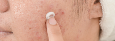 Acne bij volwassenen | Wat te doen? | Sproet