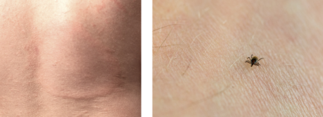 Tekenbeet | Oorzaak en tips | Sproet