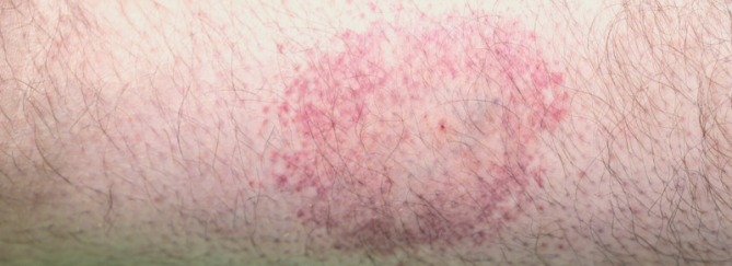 Tekenbeet | Oorzaak en tips | Sproet