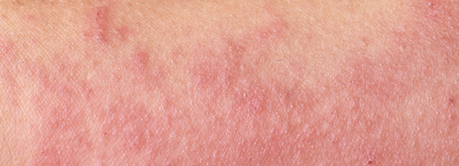 Probiotica | Smeren of slikken | Sproet