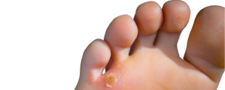 Wrat | Oorzaak en behandeling | Sproet