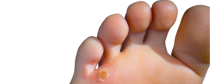 Wrat | Oorzaak en behandeling | Sproet