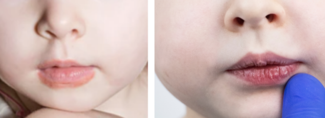 Liplik eczeem | Oorzaak en behandeling | Sproet